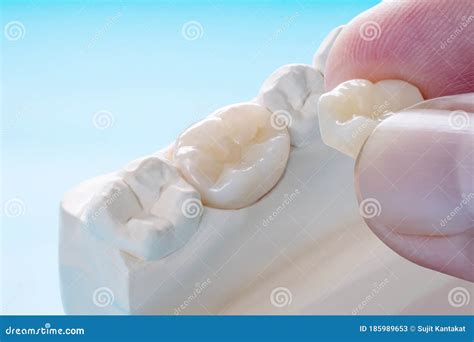 Prosthodontics Or Prosthetic Stock Image Image Of Background Medical