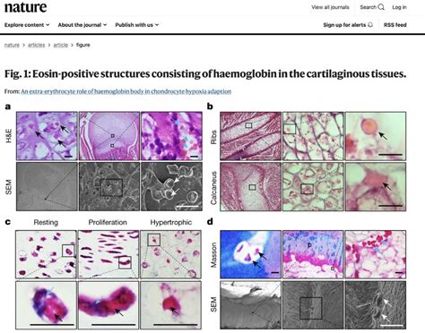 Histology Hedy Pathologist Hemepath Pedipath Pathology Miguel Reyes Múgica