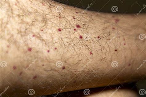 Vasculitis Vasculitis In Legs Small Red Or Purple Spots Rare Disease