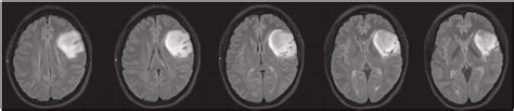 Brain MRI Of A Years Old Female Brain MRI Showed An Inflitrative Download Scientific