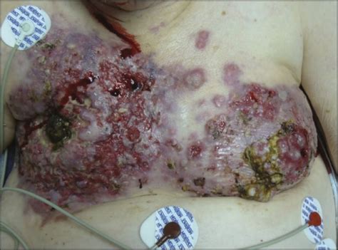 【閲覧注意】見た瞬間「あ、この人もう無理だな」って分かる癌患者の画像 ポッカキットポッカキット