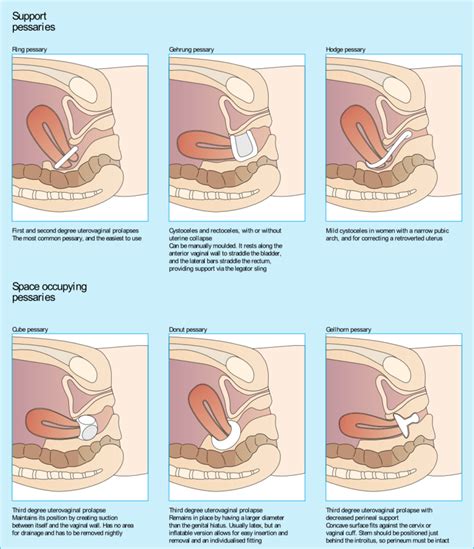 What Are Pessaries And How Do They Work