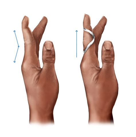 Ring Splints For Ehlers Danlos Syndrome And Hypermobility Spectrum