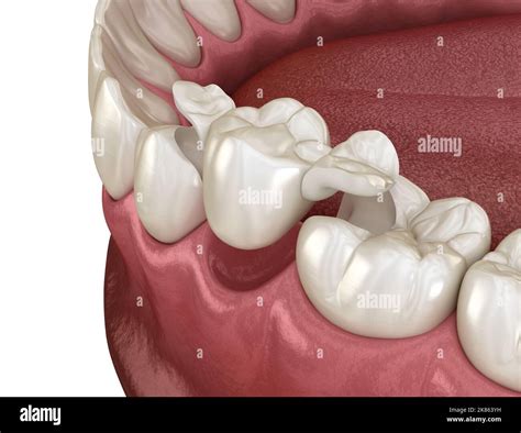 Dental Cement For Maryland Bridge At Augustine Chambers Blog