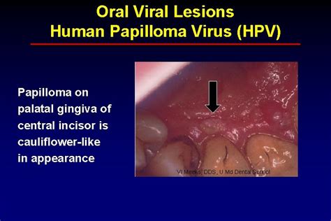 Module 7 Oral Lesions Associated With Hiv Disease