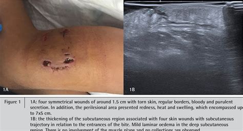 Pdf Cellulitis Due To Pasteurella Stomatis And Actinomyces Canis