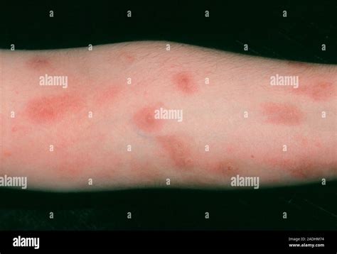 Psoriasis Dithranol Treatment Close Up Of The Arm Of A Young Patient