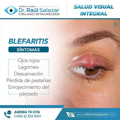 Blefaritis Blefaritis Oftalmología Quito Facebook