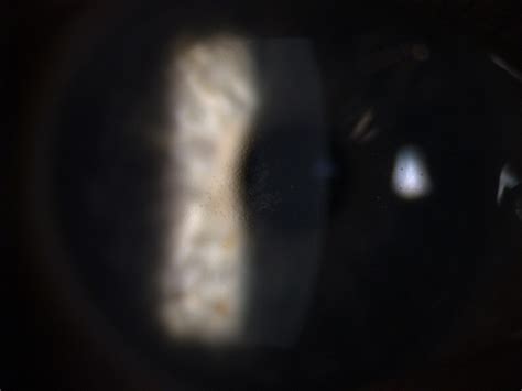 Fuchs Endothelial Dystrophy Cornea And Conjunctiva Advanced Eye