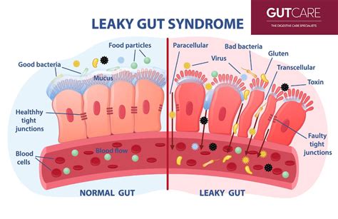 Leaky Gut What It Is And How To Heal It Gastroenterology 52 Off