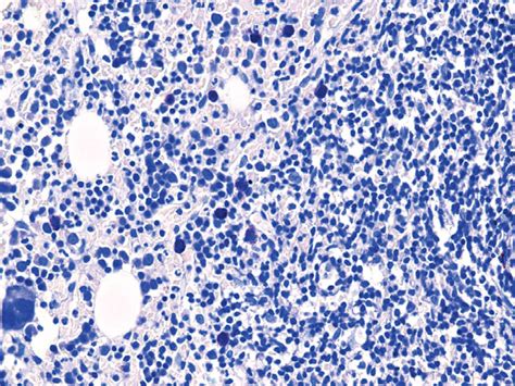 28 Nodular Mature Lymphoid Aggregate Devoid Of Plasma Cells With Some Download Scientific