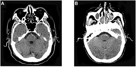 Frontiers Hyperdense Artery Sign And Clinical Outcomes After