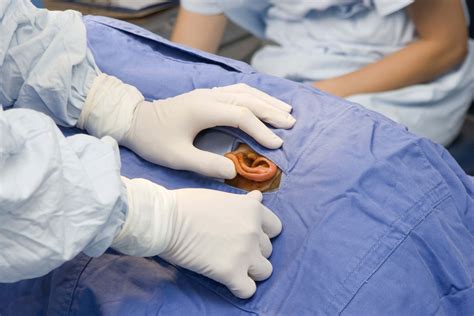 Cme Activity Stapedectomy Mds And Pas