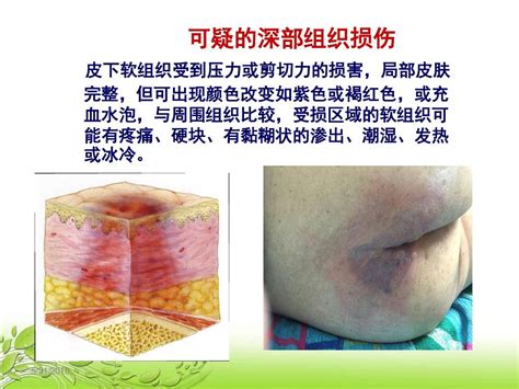 压疮的预防及护理word文档在线阅读与下载无忧文档