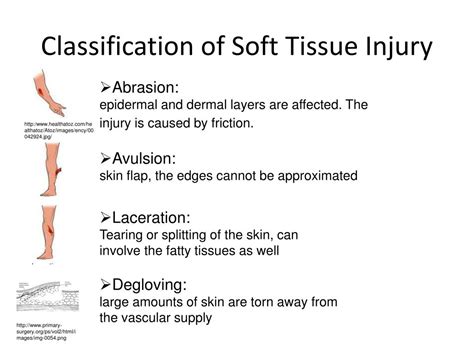 Ppt Soft Tissue Injury Powerpoint Presentation Free Download Id