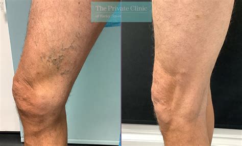 Varicose Veins 003dp Back The Private Clinic Of Harley Street London