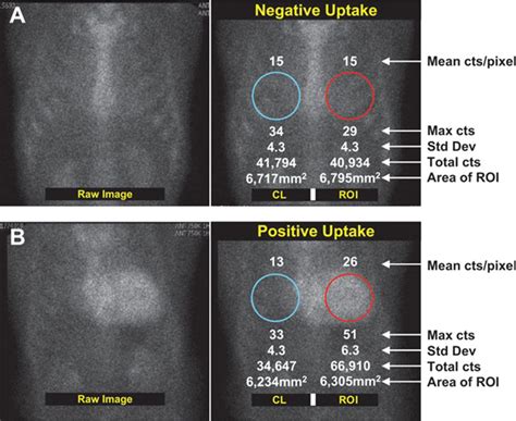 99mtc Pyrophosphate Scintigraphy For Differentiating Light Chain Cardiac Amyloidosis From The