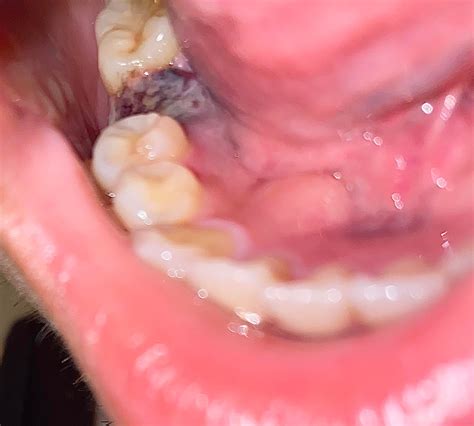 White Stuff On Tooth Extraction Site R Askdentists