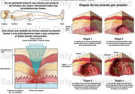 Úlceras De Decúbito úlceras Por Presión