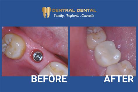 Implant To Replace Molar Central Dental