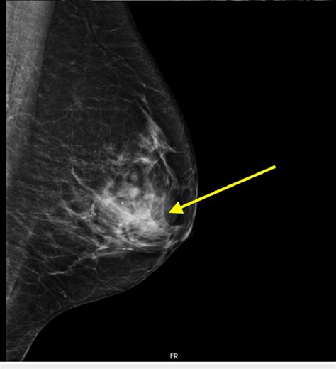 Mediolateral Oblique View Mammogram Of The Right Breast Showing The