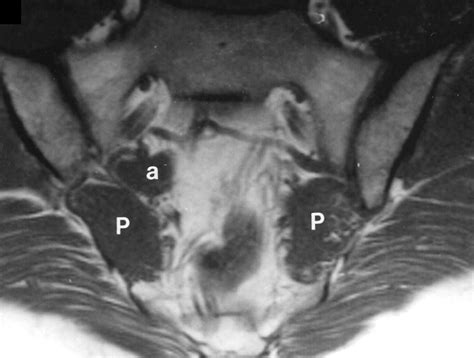 Mri Of Piriformis Syndrome Ajr