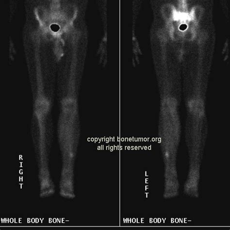 A Tumor In The Fibula Discovered By Accident