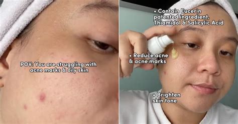 My Acne And Acne Marks Are Slowly Fading” Msians Share Reviews Of Eucerins Acne Range Life