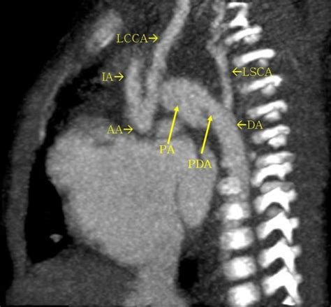 Interrupted Aortic Arch Radrounds Radiology Network