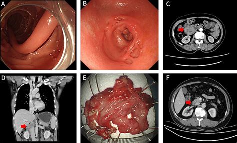 A Lesion With Pedicle Located In Descending Part Of The Duodenum B