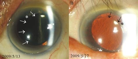 Different Intraocular Lens Iol Positions Examined On Different Dates
