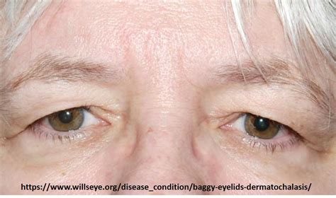 Saggy Eyelids Treatments For Droopy Eyelids In Costa Rica Ptosis