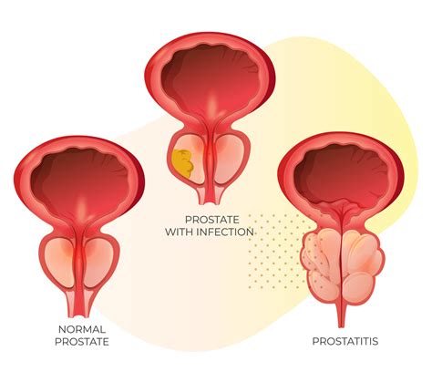 Prostate Infection Causes