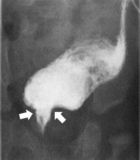Distal Loopogram Imaging Showed Suspicious Transi­ Tional Zone Arrows