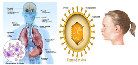 Epstein Barr Virus Symptoms