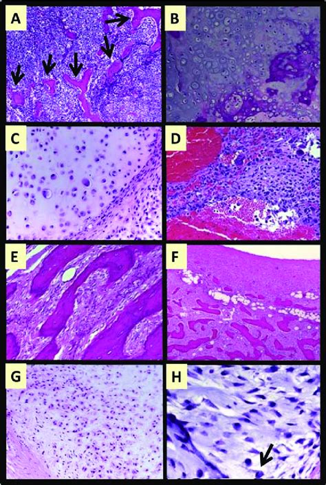 A Small Cell Osteosarcoma Permeating Normal Bone The Tumor Fills The