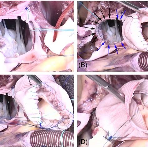A Blue Arrows Depict Displaced Aortic Annulus Of The Left Coronary