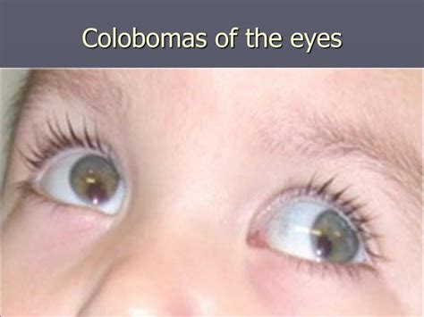 Ppt Charge Syndrome By Terri May Powerpoint Presentation Free