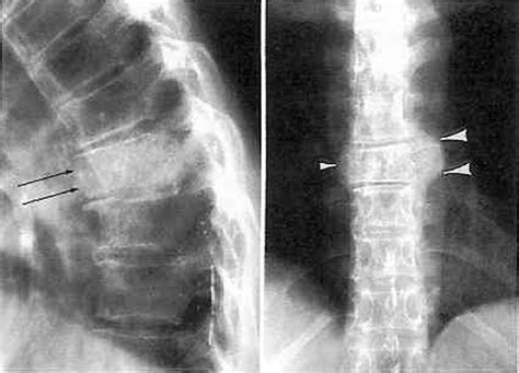 Vertebral Hemangioma