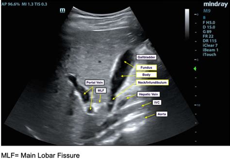 Abdomen The Gallbladder