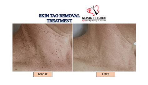 Skin Tag Chemical Peel Cryosurgery Cantharidin Laser Curettage