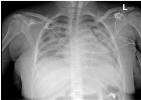 Chest X Ray Revealing Right Lower Lobe Consolidation With Extensive