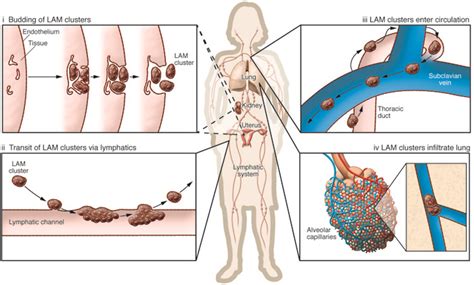 Jci Lymphangioleiomyomatosis — A Wolf In Sheeps Clothing