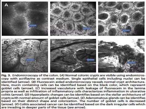 Ulcerative Colitis Pptx