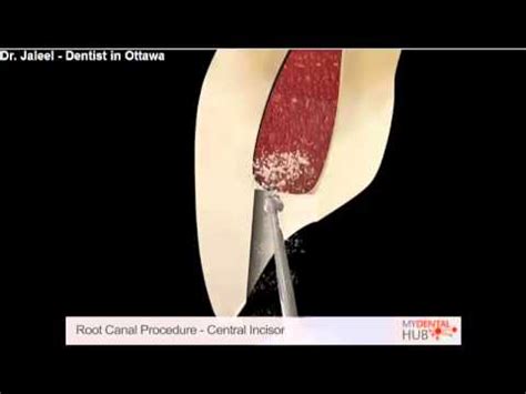 Endodontics Root Canal Procedure Central Incisor Dentist Ottawa Youtube