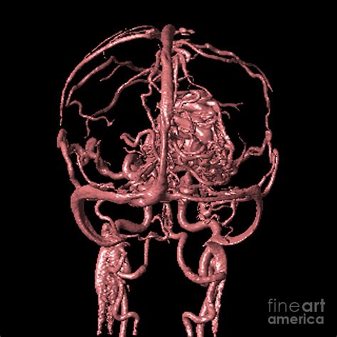 Brain Arteriovenous Malformation 1 Photograph By Simon Fraser