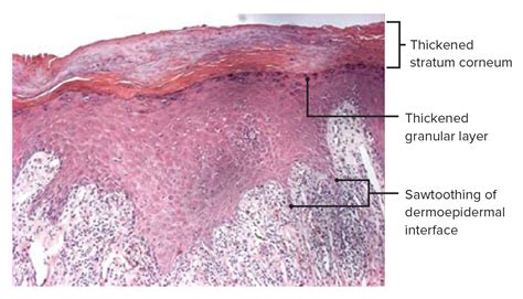 Lichen Planus Concise Medical Knowledge