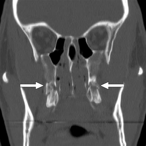 How To Simplify The Ct Diagnosis Of Le Fort Fractures Ajr