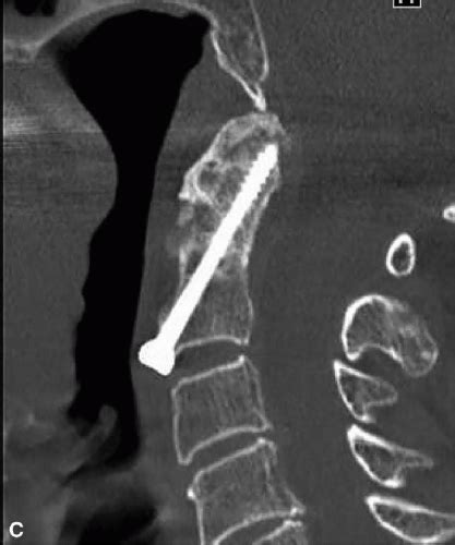 Odontoid Screw Fixation Musculoskeletal Key