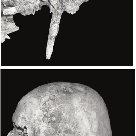 Oc 00208 Left Styloid Process Note The Swelling At The Site Of